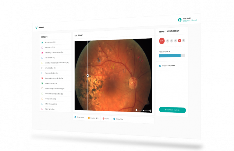 Retinal Analysis - Viderai